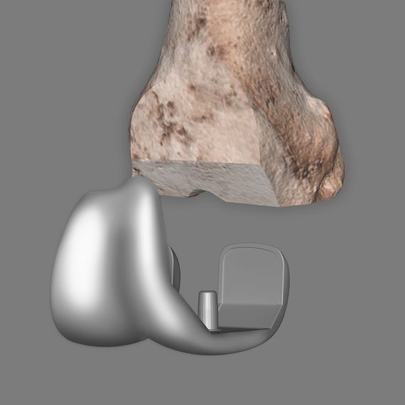 The artificial Knee Joint - ARTIQO Endoprothetik